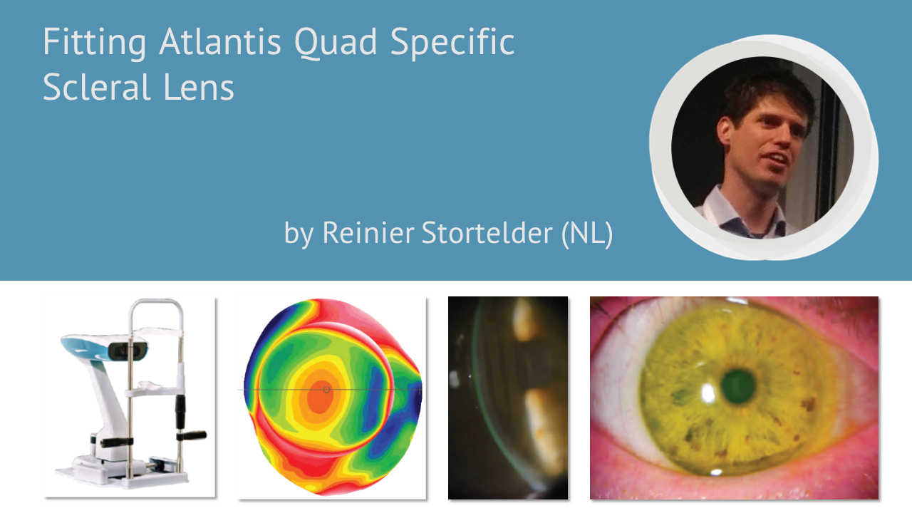 Atlantis Scleral by X-Cel: Easy fit with the Eye Surface Profiler