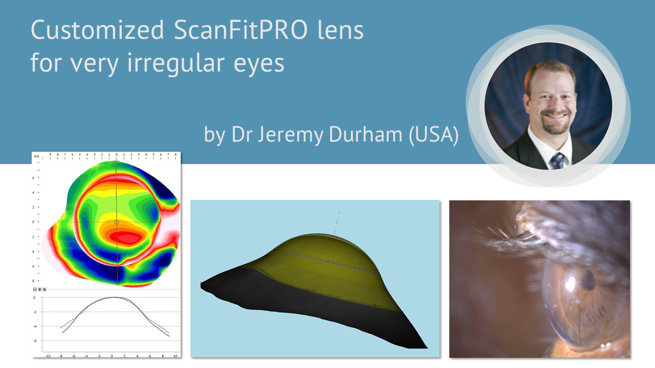 ScanFitPRO by EyePrint Prosthetics: Easy fit with the Eye Surface Profiler