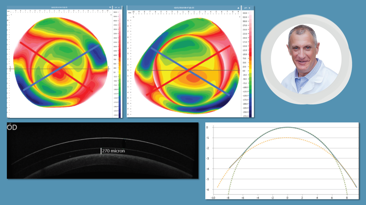 Zenlens by Bausch+Lomb: Easy fit with the Eye Surface Profiler
