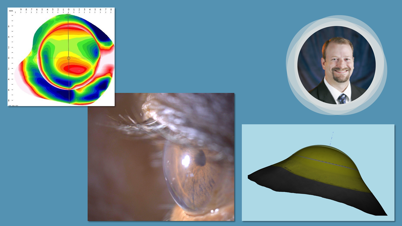 ScanFitPRO by EyePrint Prosthetics: Easy fit with the Eye Surface Profiler