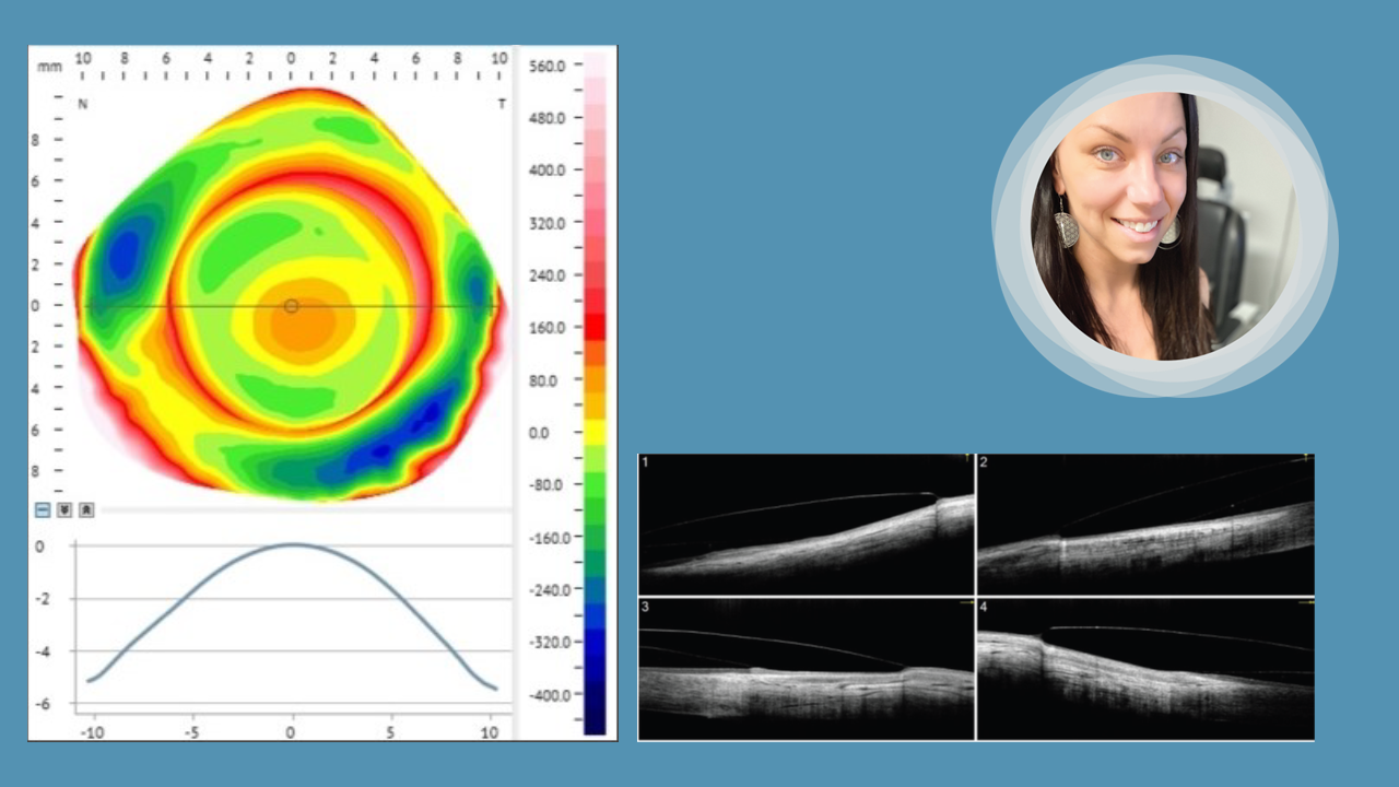 BostonSight SCLERAL: Easy fit with the Eye Surface Profiler