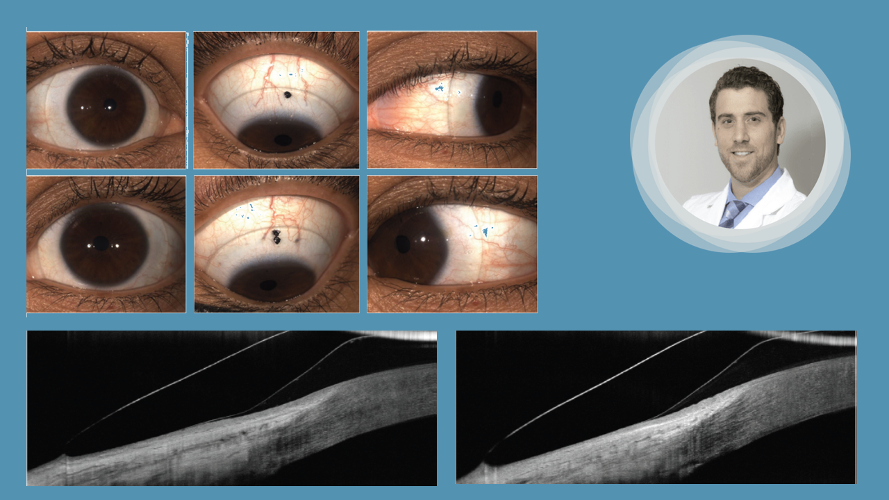 BostonSight SCLERAL: Easy fit with the Eye Surface Profiler