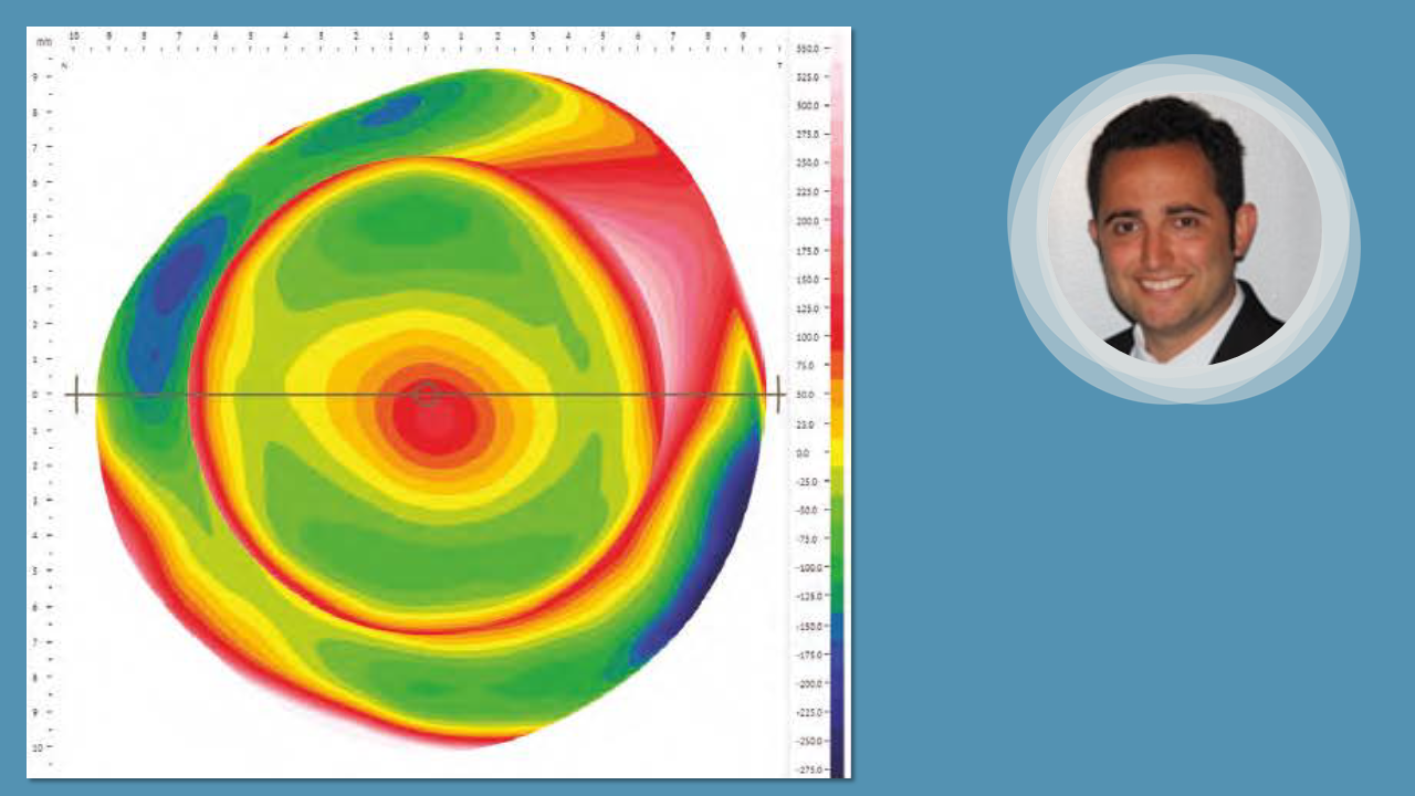 MAXIM 3D and MAXIM by AccuLens: Easy fit with the Eye Surface Profiler