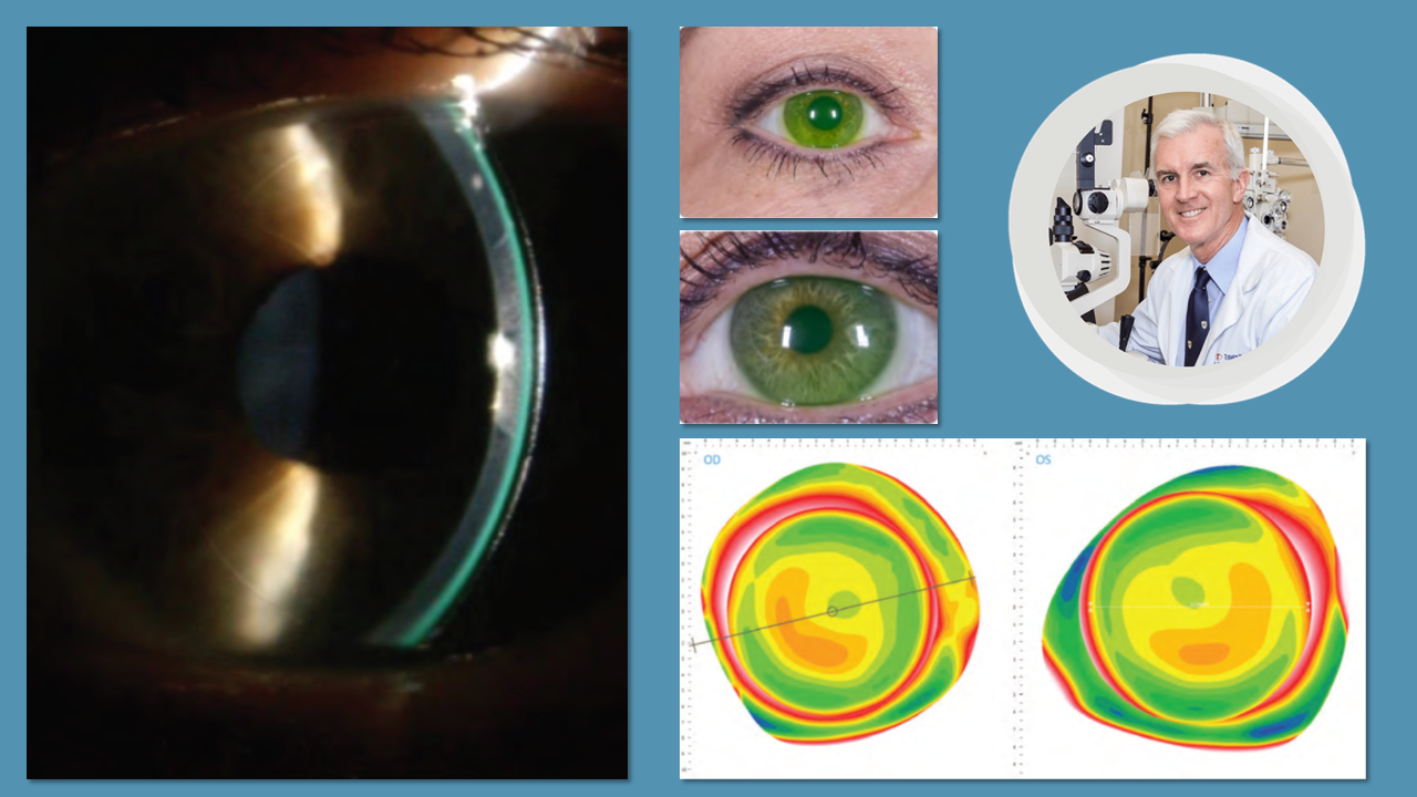 Onefit MED and MED+ by Blanchard: Easy fit with the Eye Surface Profiler